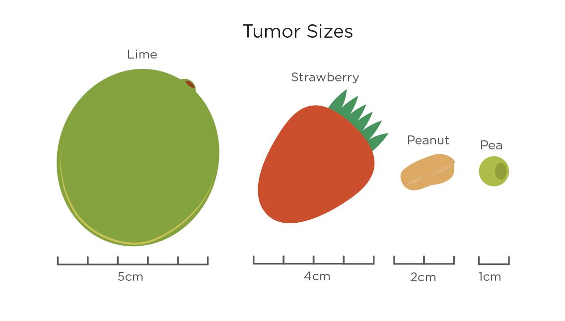Stages & Grades Of Breast Cancer | My Breast Cancer Compass Stages & Grades Of Breast Cancer | My Breast Cancer Compass